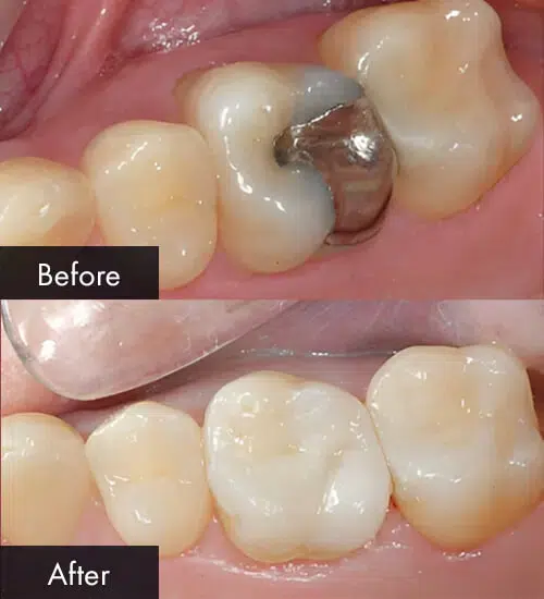 Dental Porcelain Onlays in Joplin MO - Joplin Family Dental